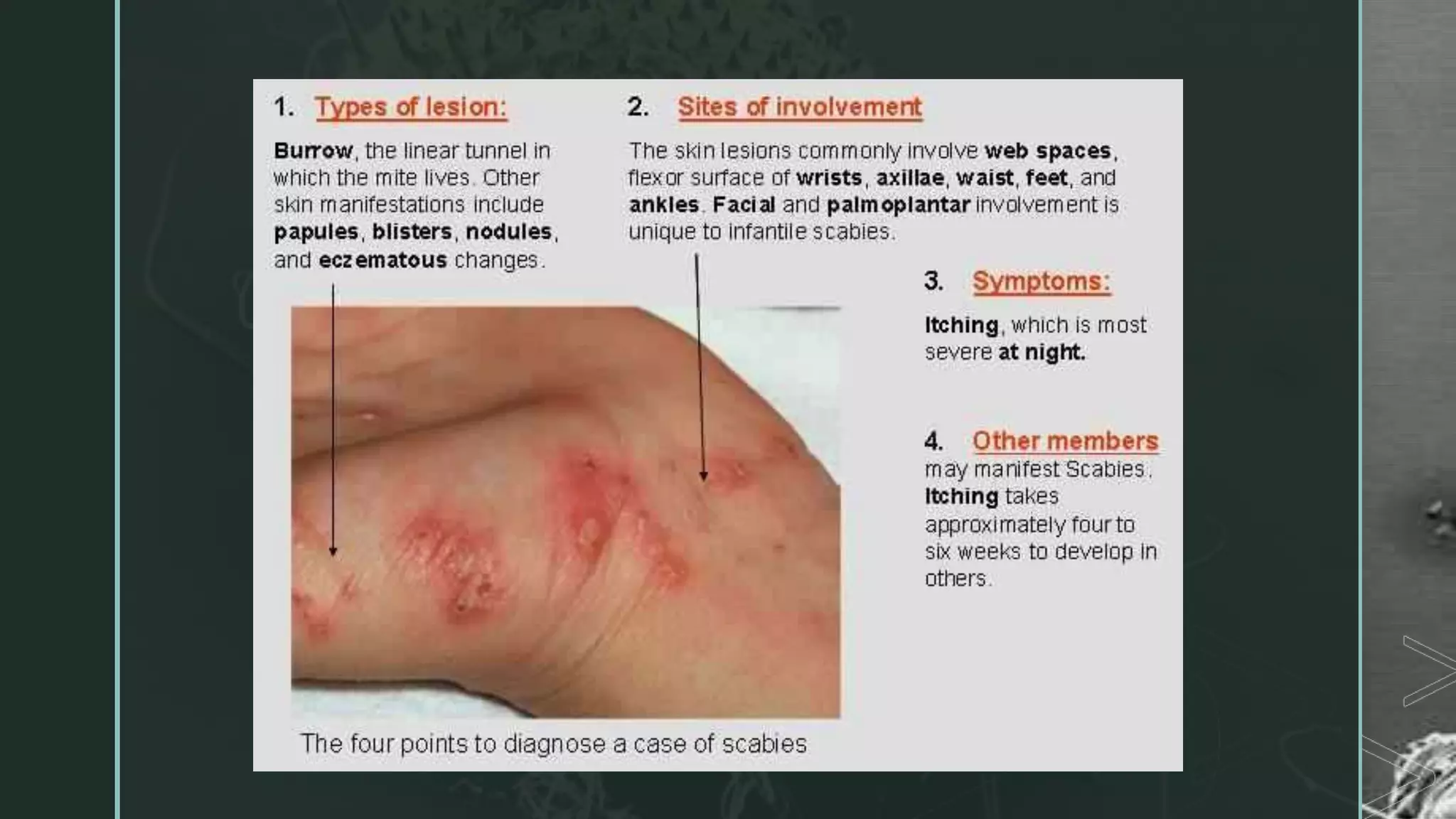 Scabies | PPTX