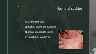 Scabies | PPTX