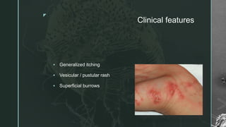 Scabies | PPTX