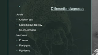 Scabies | PPTX