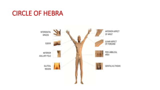 Scabies and pediculosis | PPTX