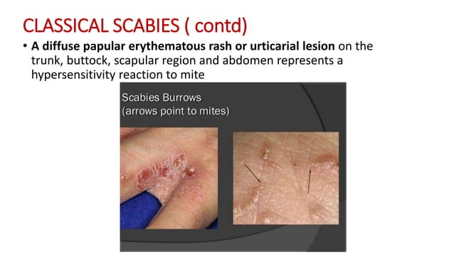 Scabies and pediculosis | PPTX | Skin and Dermatology | Diseases and ...