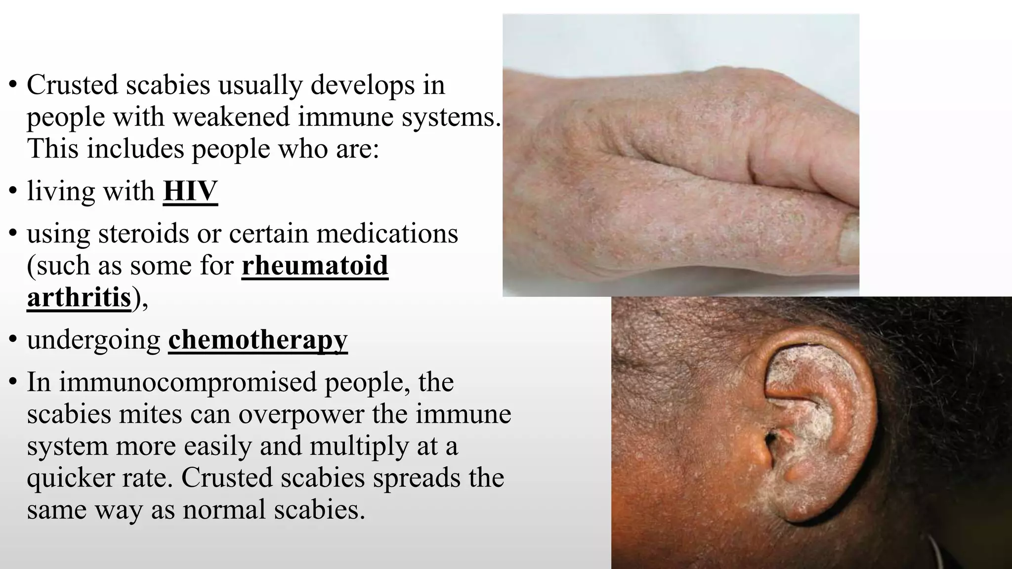 SCABIES BY DR MALZ.pptx