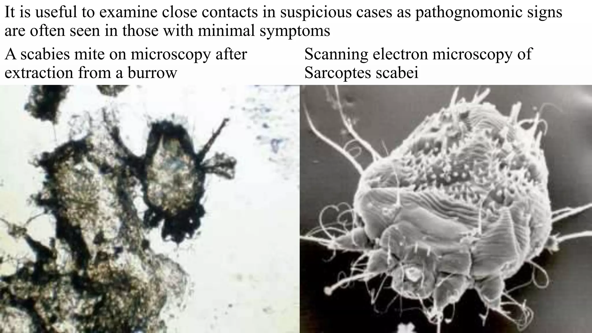 SCABIES BY DR MALZ.pptx