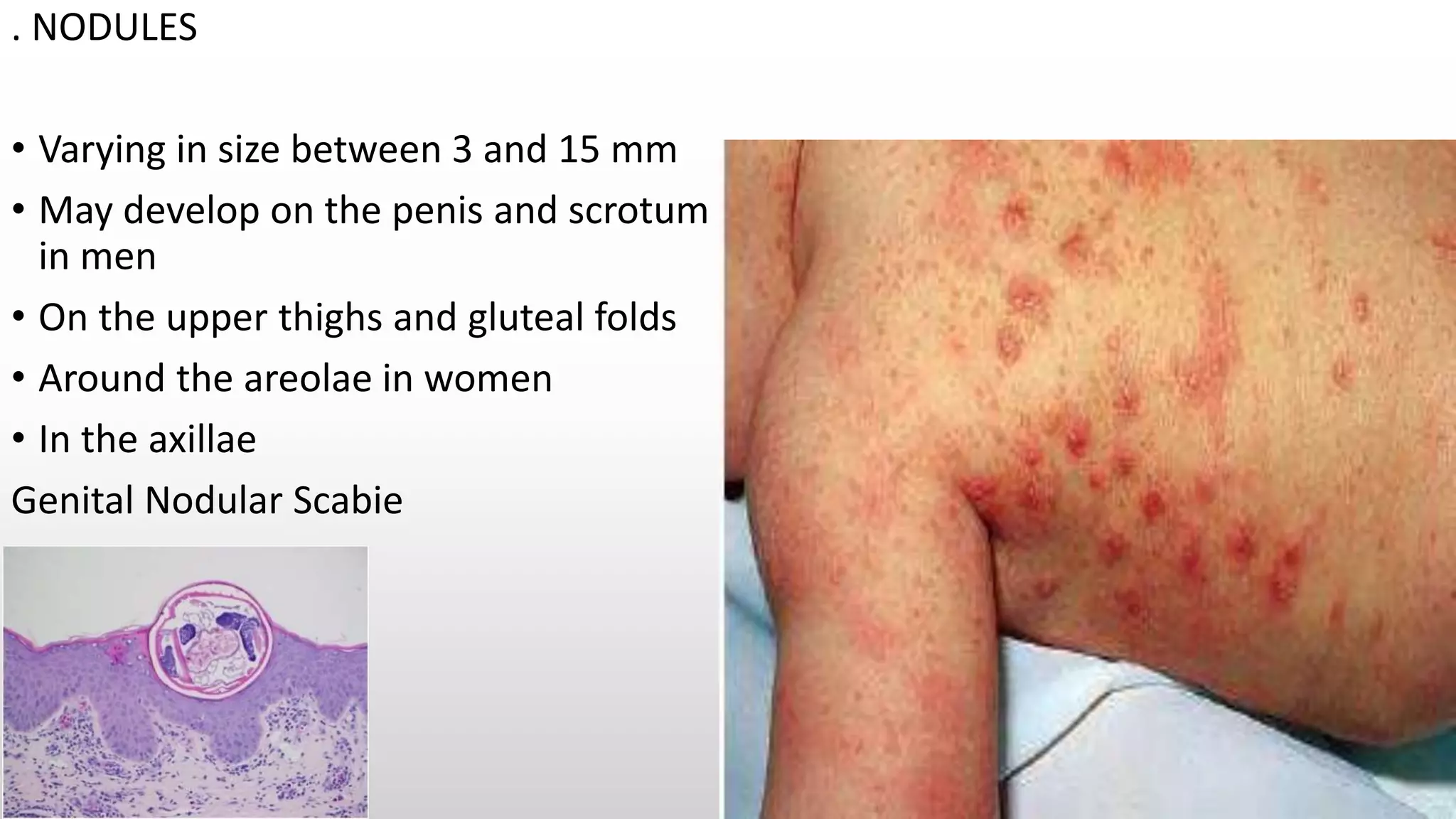 SCABIES BY DR MALZ.pptx