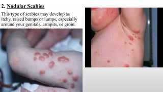 SCABIES BY DR MALZ.pptx