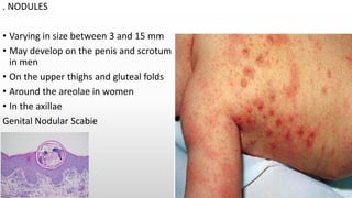 SCABIES BY DR MALZ.pptx