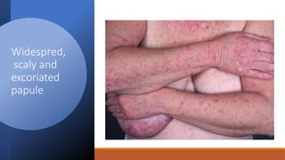 scabies by master doctor fadhly shariman.pptx