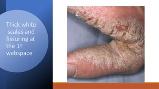 scabies by master doctor fadhly shariman.pptx