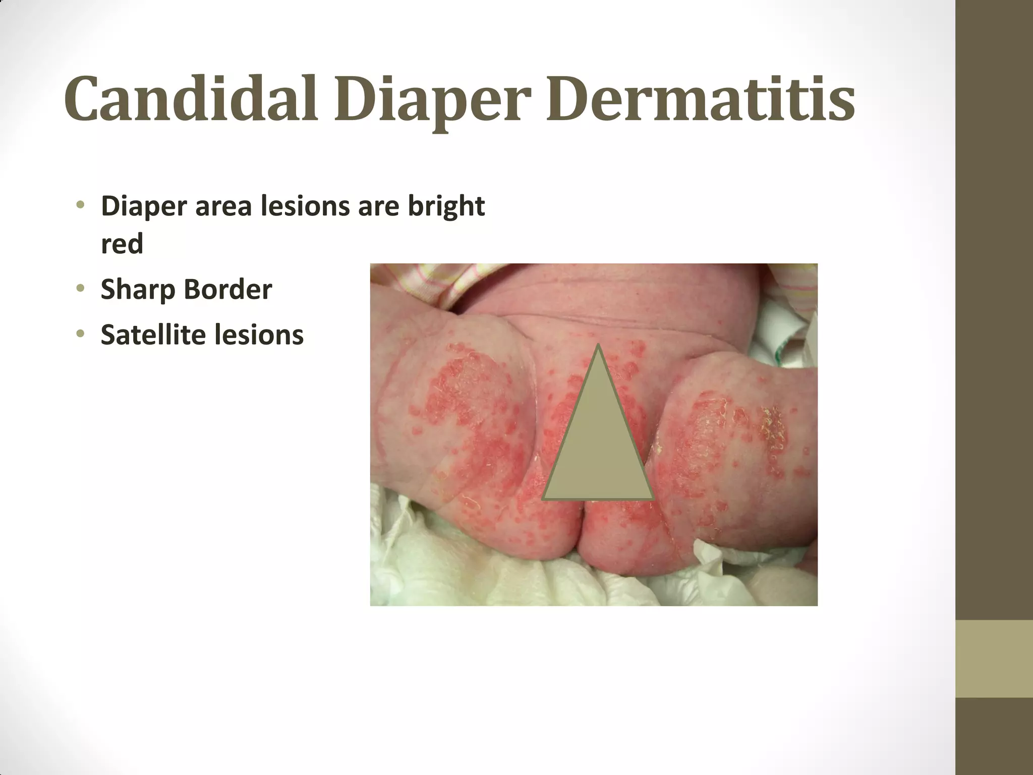 Scabies, cellulitis ihope ping | PDF