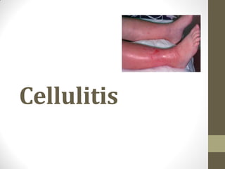 Scabies, cellulitis ihope ping | PDF