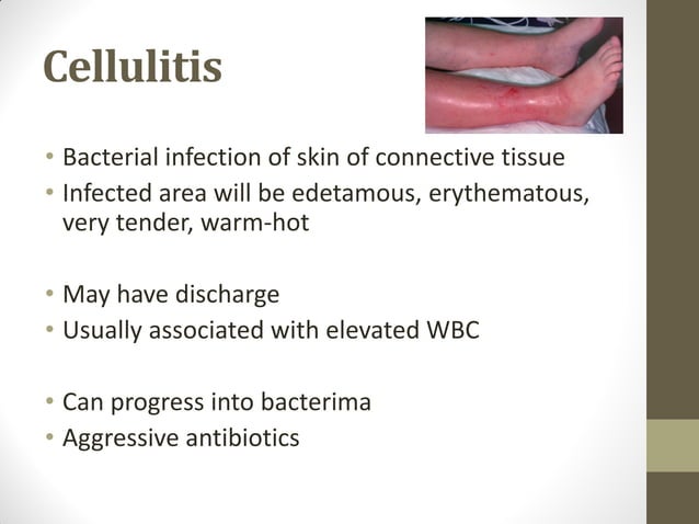 Scabies, cellulitis ihope ping | PDF