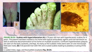 Scabies [Derma] smol.pptxbees bees bees bees | PPT