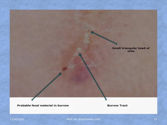 Scabies | PPT