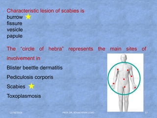 Scabies | PDF