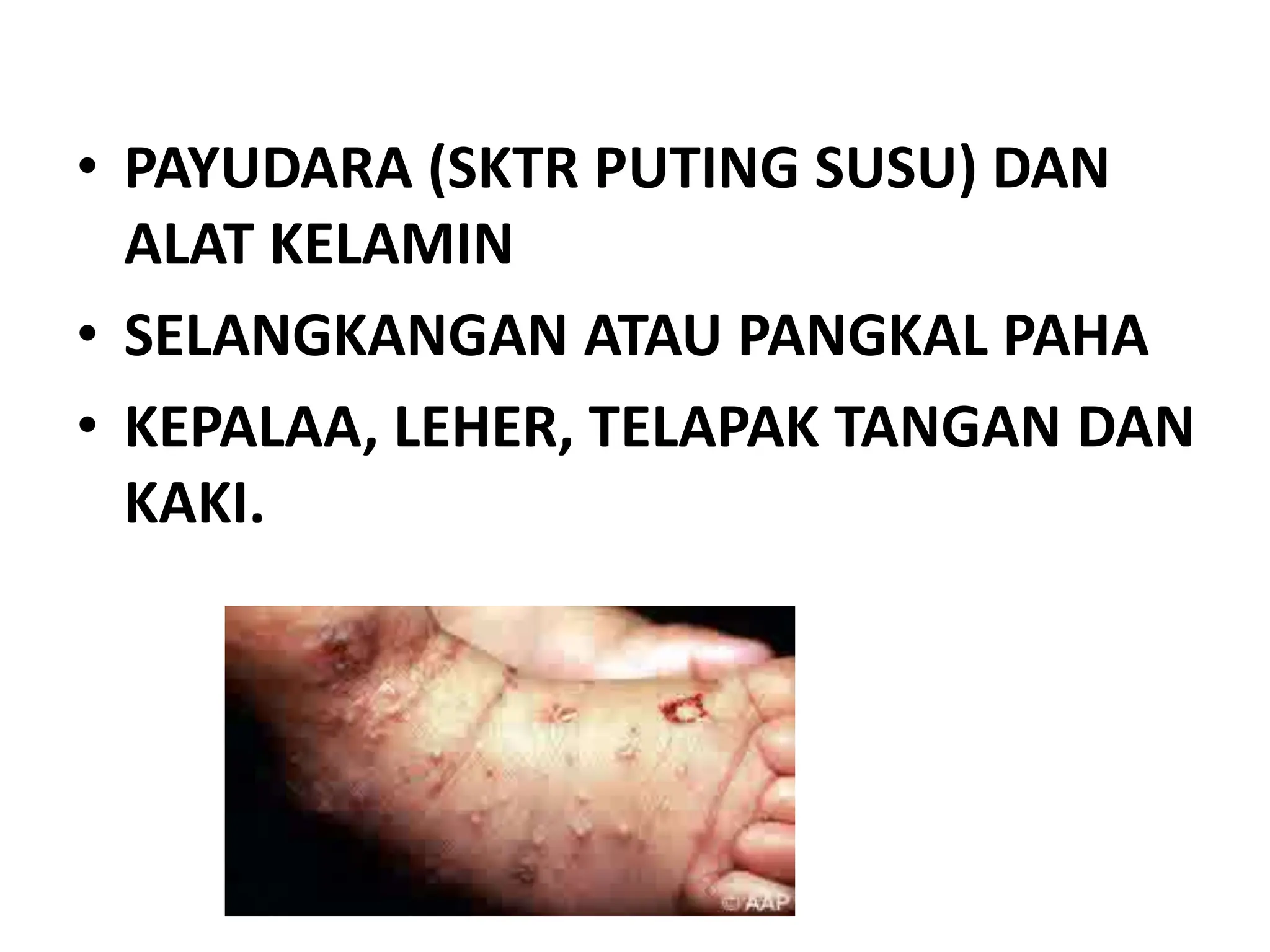 POWERPOINT TENTANG SCABIES (KUDIS/GUDIK).pptx