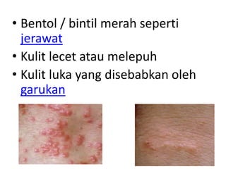 POWERPOINT TENTANG SCABIES (KUDIS/GUDIK).pptx