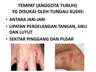POWERPOINT TENTANG SCABIES (KUDIS/GUDIK).pptx