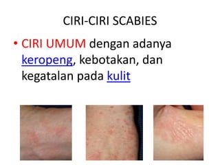 POWERPOINT TENTANG SCABIES (KUDIS/GUDIK).pptx