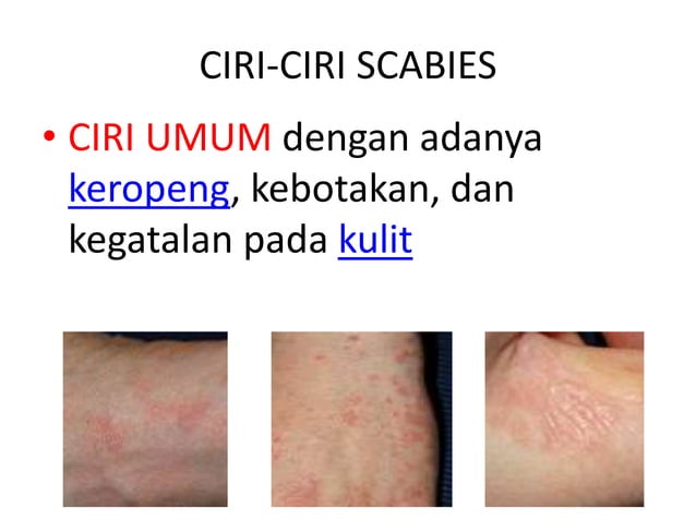 POWERPOINT TENTANG SCABIES (KUDIS/GUDIK).pptx