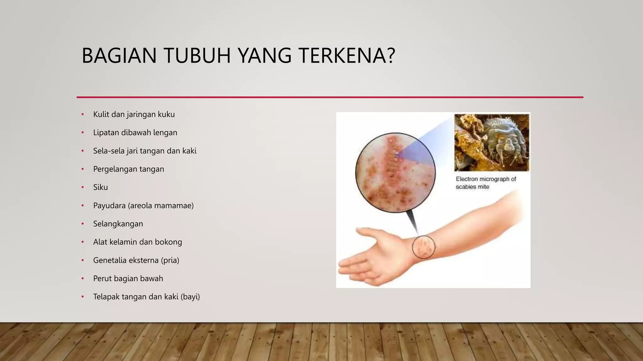 SCABIES IKE.pptx