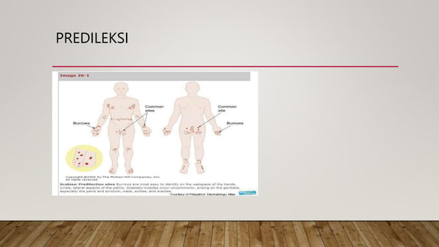 SCABIES IKE.pptx