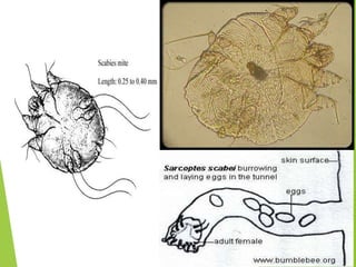 Scabies lecture.pptx