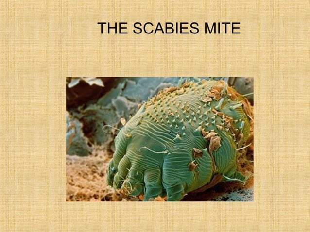 Scabies Life cycle, Diagnosis & Treatment | PPT