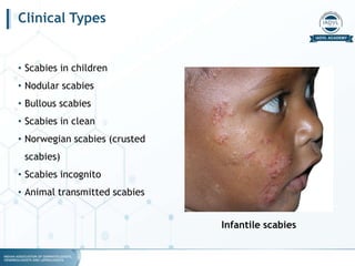 basics of diagnosis and treatment of scabies and pediculosis | PPTX