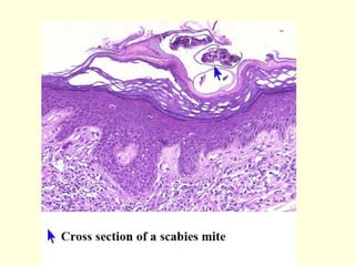 Scabies ppt | PPT