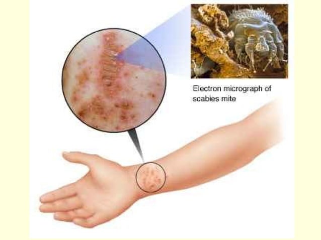 Scabies ppt | PPT | Skin and Dermatology | Diseases and Conditions