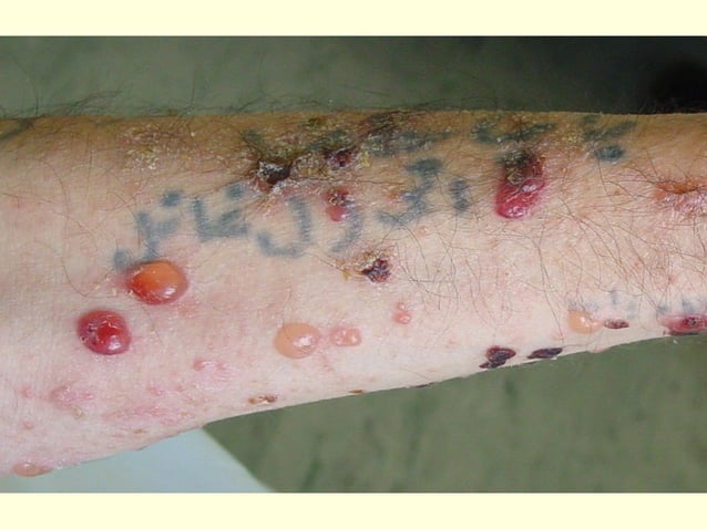 Scabies ppt | PPT | Skin and Dermatology | Diseases and Conditions