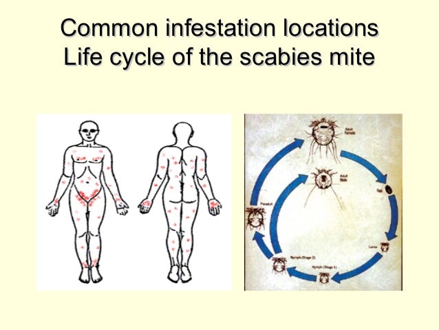 Scabies ppt