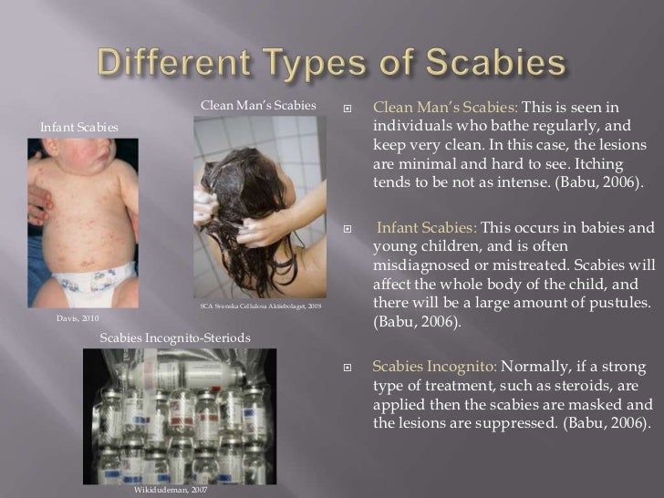 Scabies presentation 2