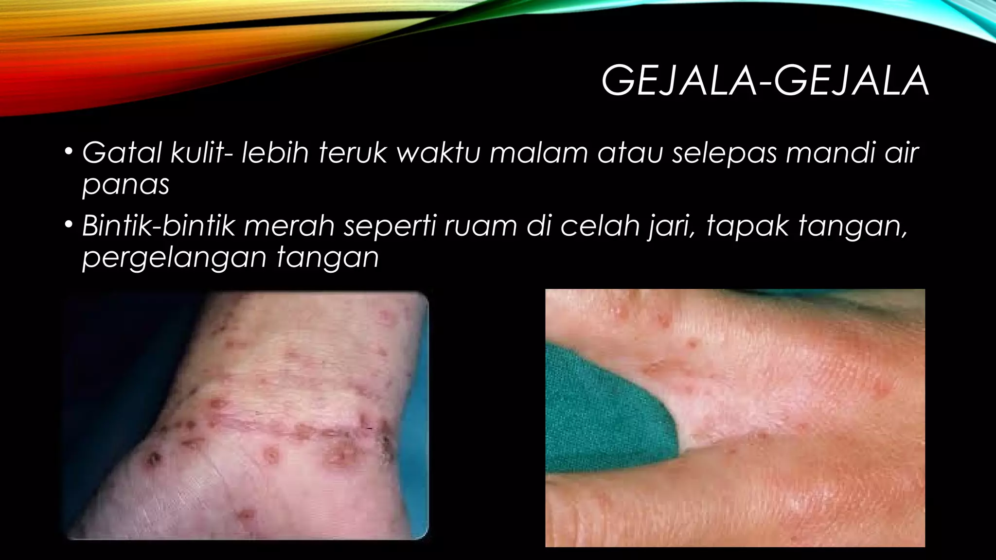 Scabies atau kudis buta utk pesakit | PPT
