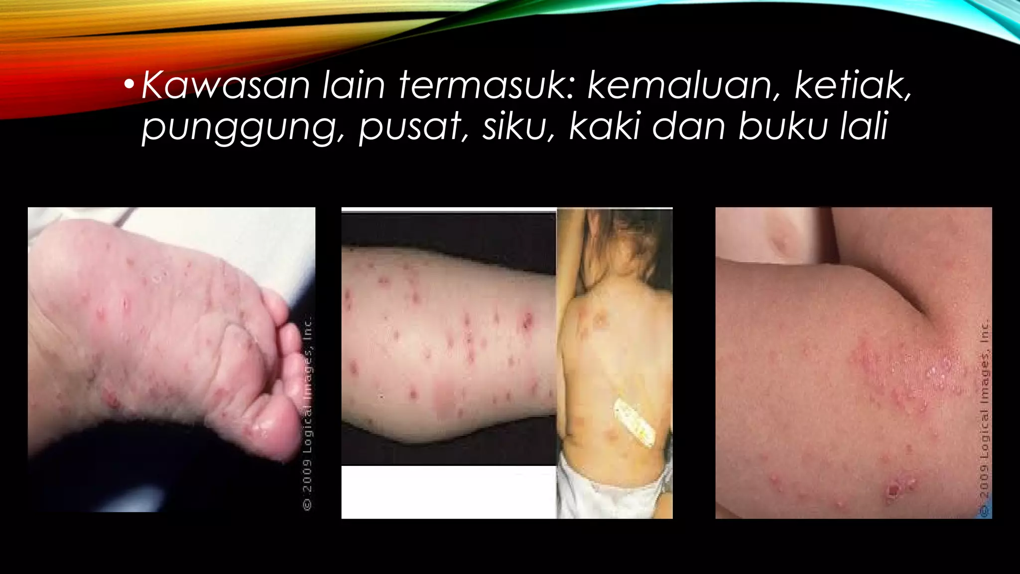 Scabies atau kudis buta utk pesakit | PPT