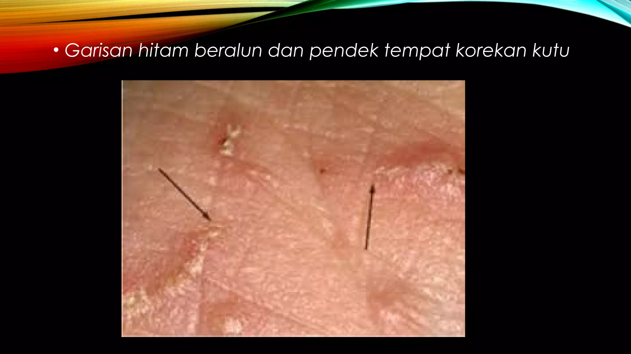 Scabies atau kudis buta utk pesakit | PPT