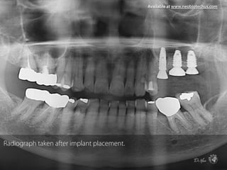 SCA Kit case(Neobiotech) | PPT