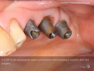 SCA Kit case(Neobiotech) | PPT