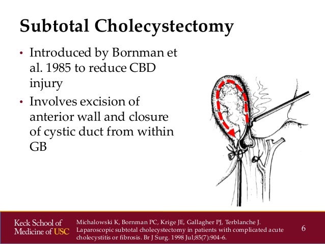 SoCal ACS 2014 - Subtotal Cholecystectomies