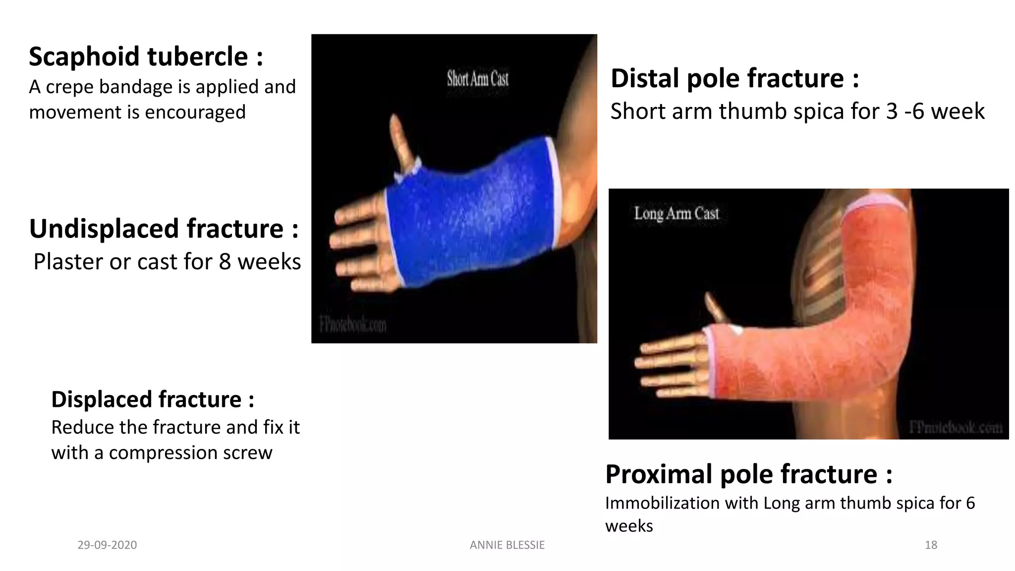 Scahpoid fracture and its physiotherapy management | PPTX