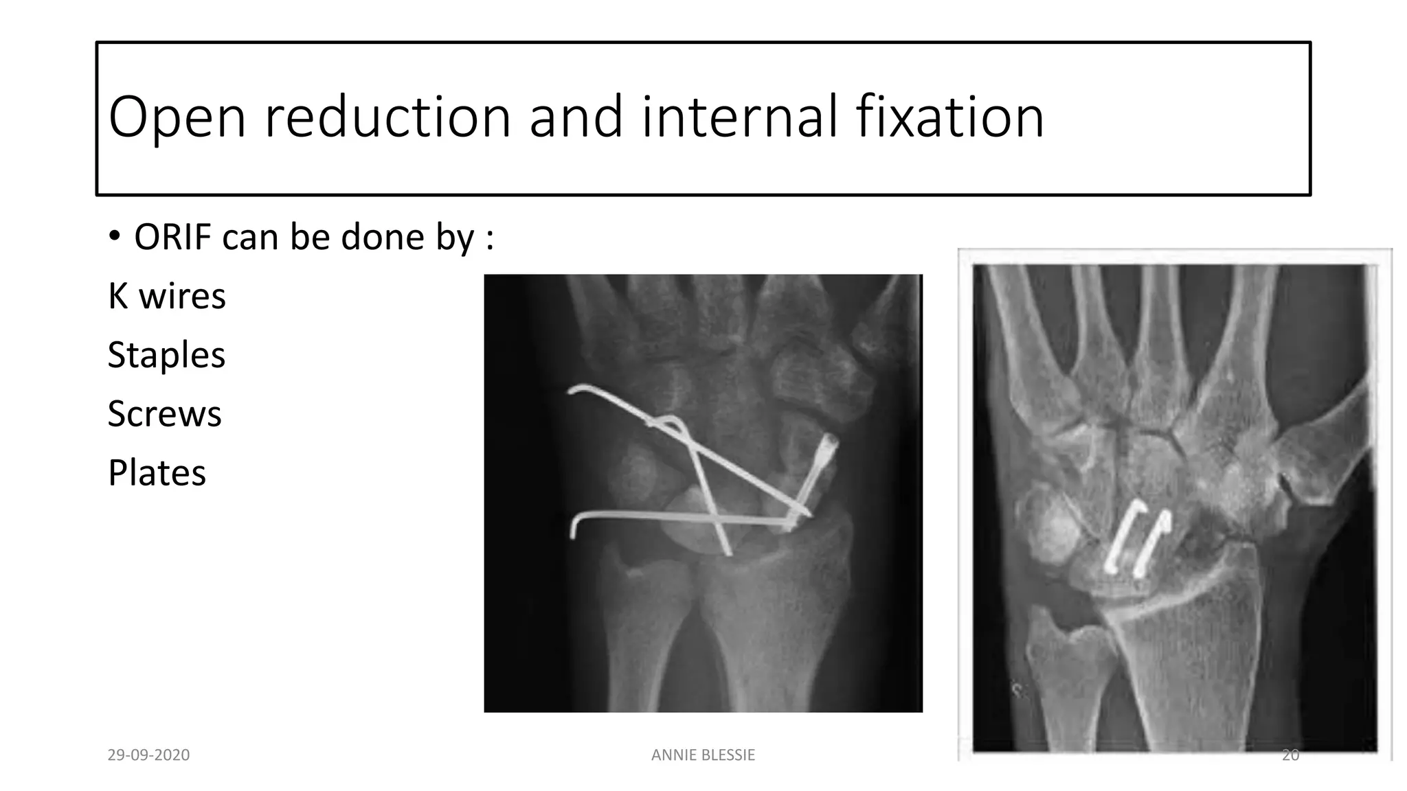 Scahpoid fracture and its physiotherapy management | PPTX