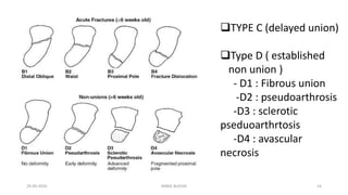 Scahpoid fracture and its physiotherapy management | PPTX