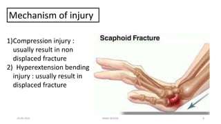 Scahpoid fracture and its physiotherapy management | PPTX