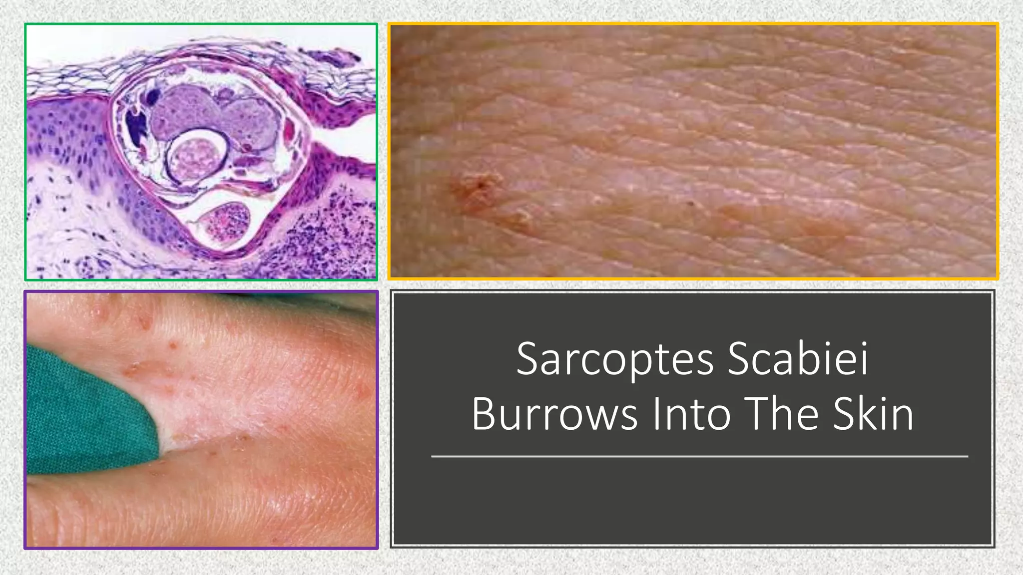 Scabies / Dermatology | PPTX