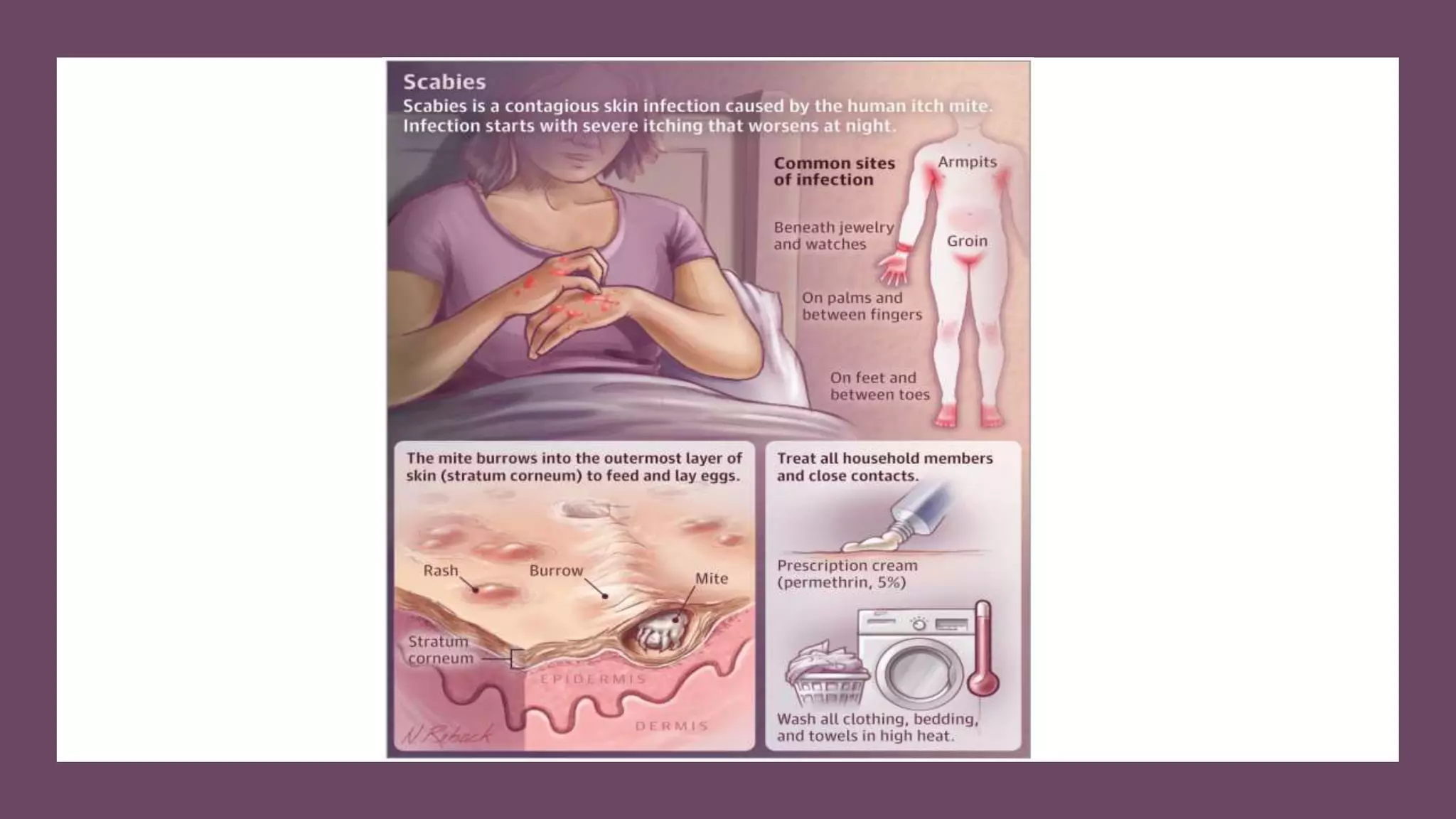 Scabies / Dermatology | PPTX