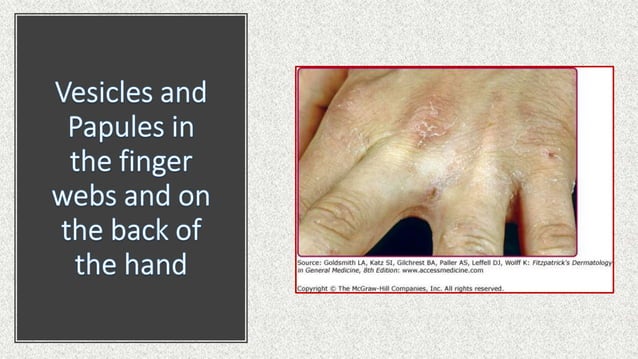 Scabies / Dermatology | PPTX