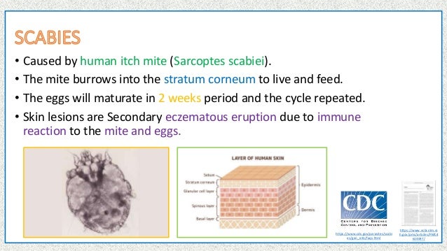 Scabies / Dermatology