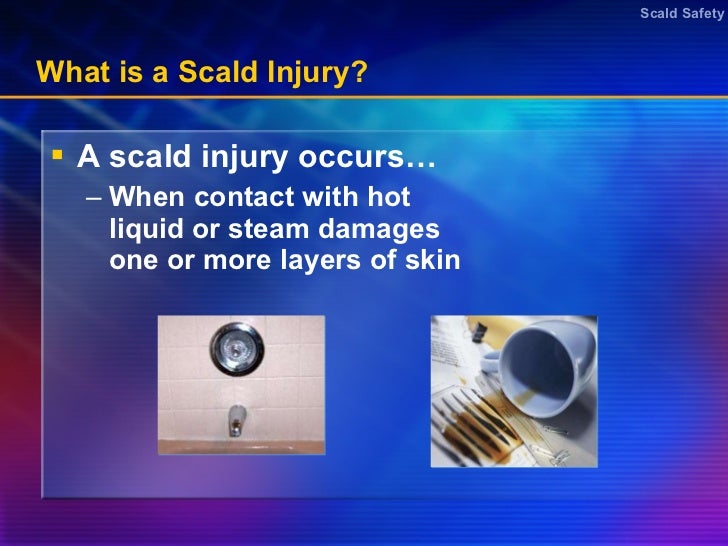 Scald injury powerpointpresentation