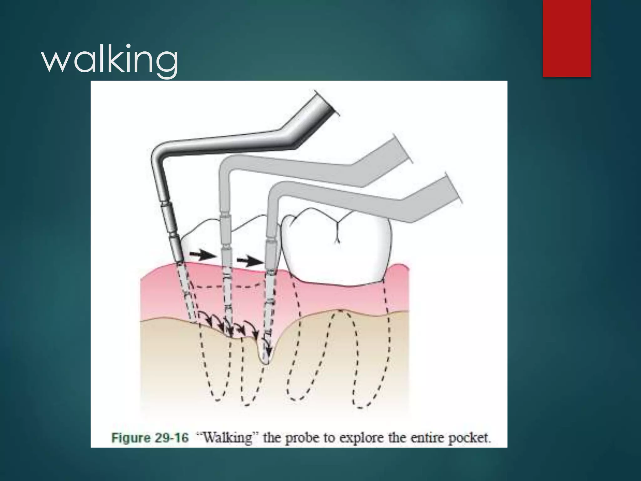 scaling and root planing instruments | PDF